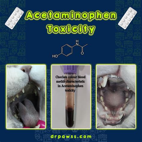 💫acetaminophen Toxicity💫 Acute Oral Intoxication Resulting From Acetaminophen Containing