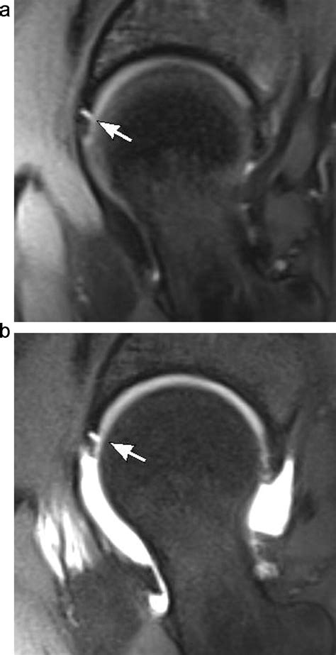 3 0t Conventional Hip Mr And Hip Mr Arthrography For The Acetabular