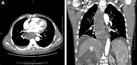 Chest Ct Images A Axial View Showing Esophageal Stenosis And A Soft