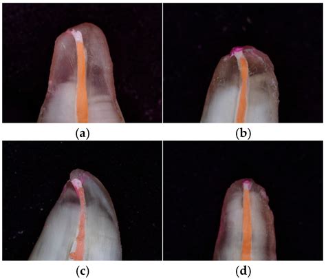 Comparison Of Apical Microleakage In Bioceramic And Resin Based Endodontic Sealers With