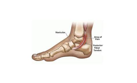 Posterior Tibial Tendon Dysfunction PodMED Podiatry