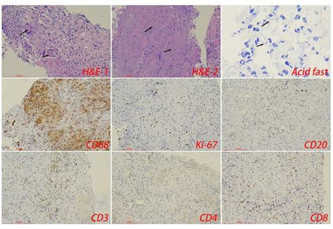 Caseous Necrosis Histology Tuberculosis Renal