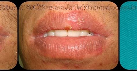 Pyogenic Granuloma Lip