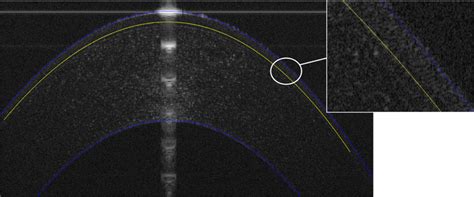 Automated Segmentation Result Of Corneal Anterior Posterior And Download Scientific Diagram