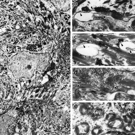 Pdf Abnormal Cornified Cell Envelope Formation In Mutilating