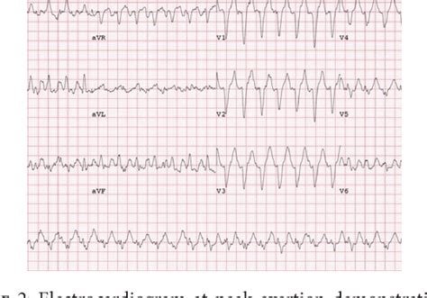 Figure 1 From Exercise Induced Left Bundle Branch Block Treated With Cardiac Rehabilitation A