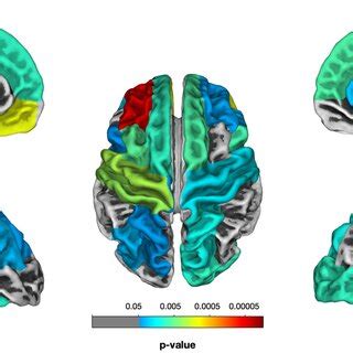 The Statistical Map For The Whole Brain Analysis In Gyrification Index Download Scientific
