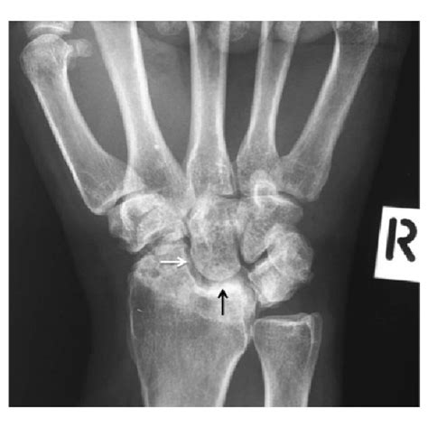 Pdf Radioscapholunate Fusion With Triquetrum And Distal Pole Of Scaphoid Excision Long Term