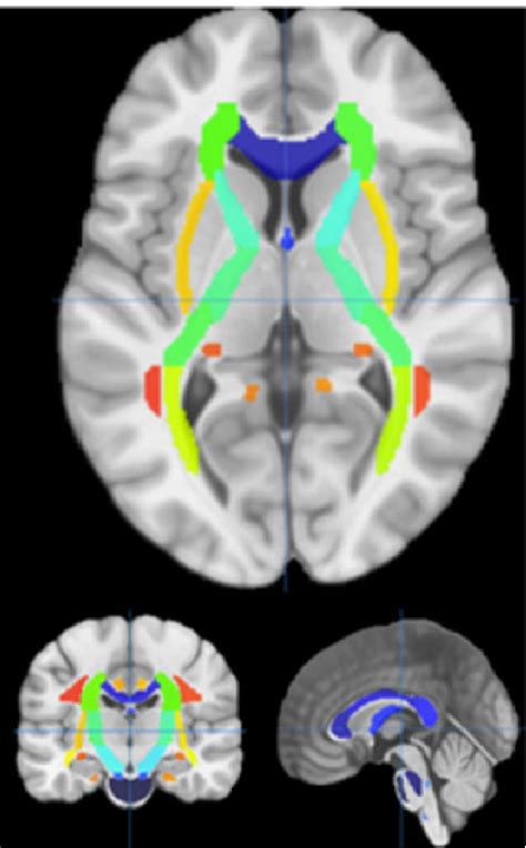 Figure 2 From Computer Aided Autism Diagnosis Using Diffusion Tensor Imaging Semantic Scholar