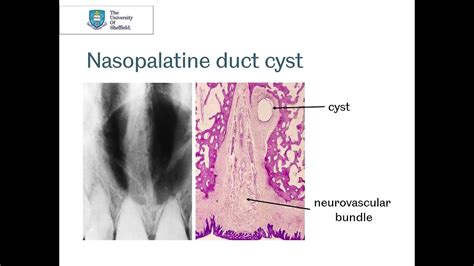 Nasopalatine Duct Cyst Differential Diagnosis
