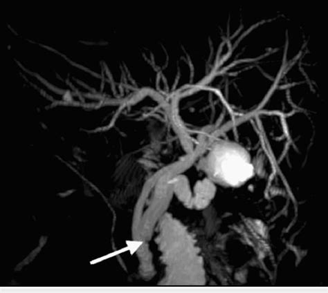 Mrcp Image Showing Low Insertion Of The Cystic Duct Stump With Distal