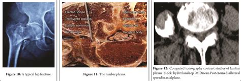 Combined Lumbar And Sacral Plexus Block In Geriatric High Risk Patients Undergoing An Awake