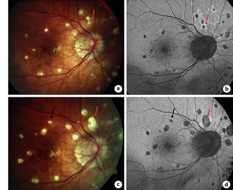 Idiopathic Multifocal Choroiditis And Punctate Inner Choroidopathy Evaluation Of Risk Factors
