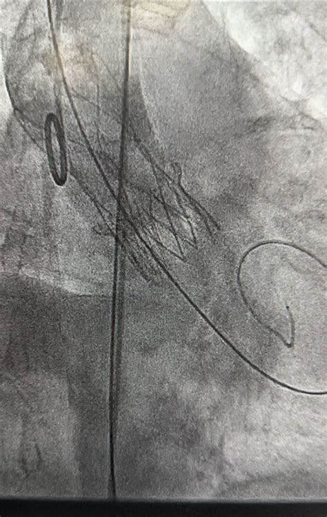Pci To Lad Proximal Shockwave Tavi Boston Scientific Cardiology Al Said Ismael
