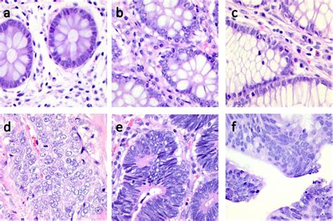 Cnn Classification Model For Lung And Colon Cancer Images Tori Sugden