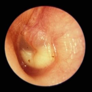 Acute Otitis Media