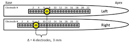 A Schematic Showing Interaural Place Of Stimulation Mismatch When