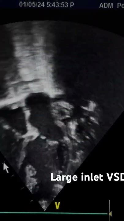 Large Inlet Vsd Echocardiogram Youtube