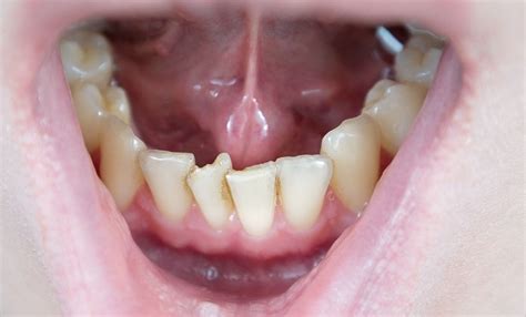 Teeth Crowding Treatment In Thaltej Ahmedabad Crowding Treatment