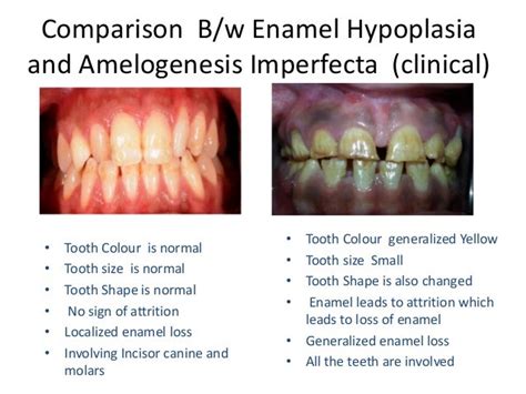 Molar Incisor Hypoplasia Dr Arsalan