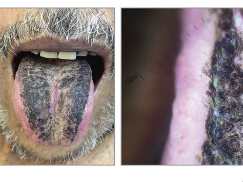 Green Black Hairy Tongue Black Hairy Tongue Caused By Metronidazole