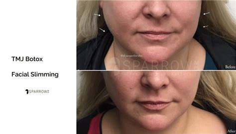 Facial Slimming Botox Vancouver