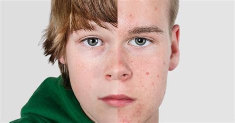 O Que é Puberdade Precoce E Quando é Necessário Bloquear Os Hormônios O Popular