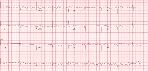 Teaching Medicine Tutorial Rhythm Diagnostic Criteria