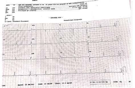 Ecg Showing Prolonged Qtc Interval Download Scientific Diagram