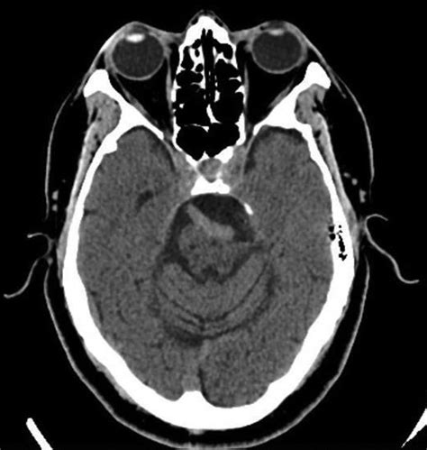 Noncontrast Cranial Computed Tomography Scan Download Scientific Diagram
