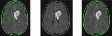 Figure 5 From Tumor Identification In Brain Mri Images Using Fuzzy C Means Algorithm Semantic