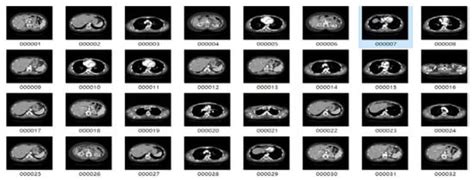 Using 2d Cnn With Taguchi Parametric Optimization For Lung Cancer Recognition From Ct Images