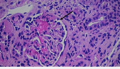 Renal Biopsy Demonstrating Diffuse Glomerular Sclerosis Fibrin Download Scientific Diagram