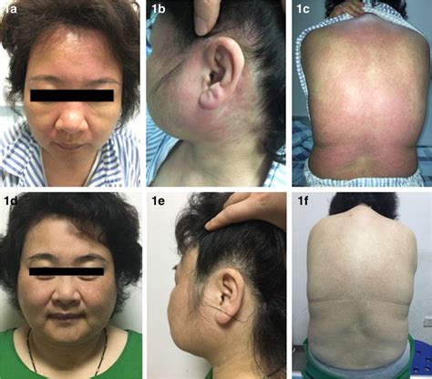 The Diffuse Erythema Distributed In Face A Scalp B And Back C Download Scientific