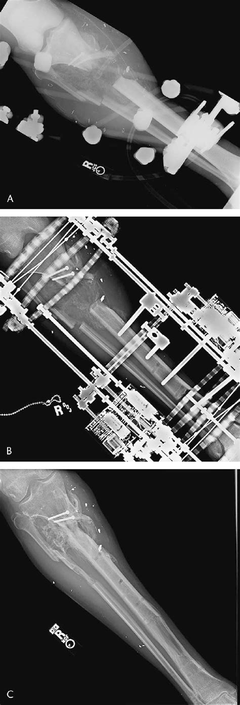 A Anteroposterior Radiograph Of Proximal Third Tibia Fracture After Download Scientific
