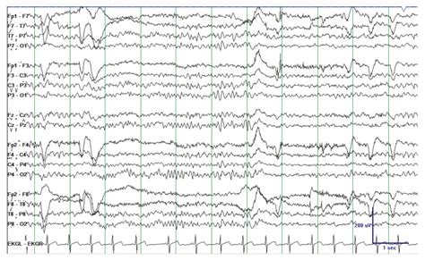 Seizure And Interictal Electroencephalographic EEG Changes With Cannabinoid Concentrate Use