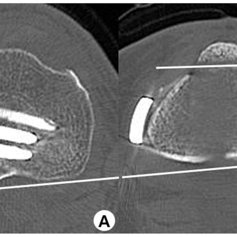 Measurement Of The Tibial Osteotomy Angle A The Line Adapted To The Download Scientific