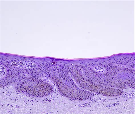 Seborrheic Keratosis Histology