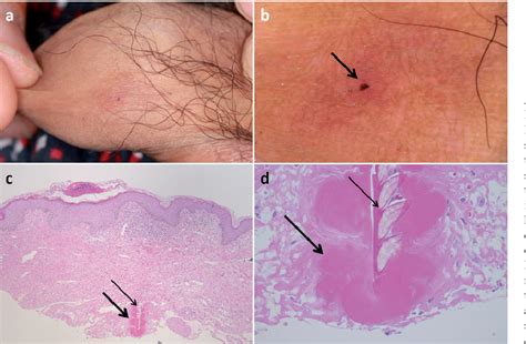Figure 1 From Tick Attachment Cement With A Feeding Cavity In The Deep Dermis Of The Penis