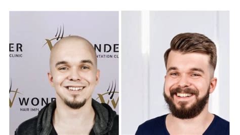 Fue Hair Transplant Turkey Procedure Cost And Reviews Wonder Hair Clinic