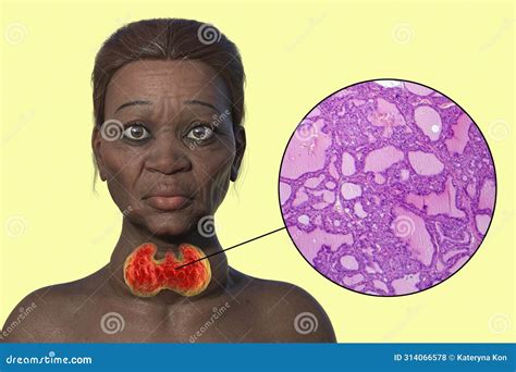 Toxic Goiter 3d Illustration And Micrograph 302528511
