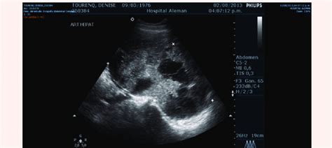 Liver Enlargement Because Multiple Nodular Solid Images Attributables Download Scientific