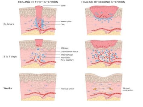 Granulation Tissue Formation