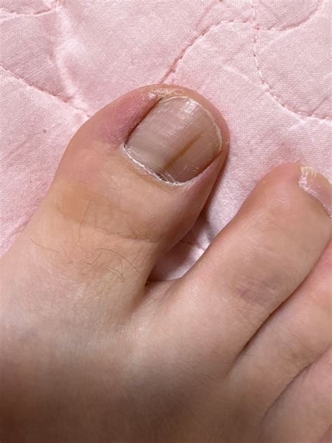 발톱에 갈색 줄이 점점 길어져요 지식in