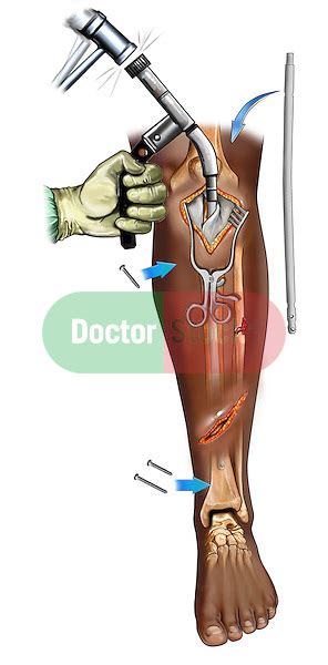 Intramedullary Rod Tibia