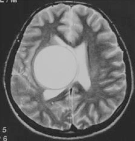 Right T2 Weighted Axial Image Showing A Gigantic Right Thalamic