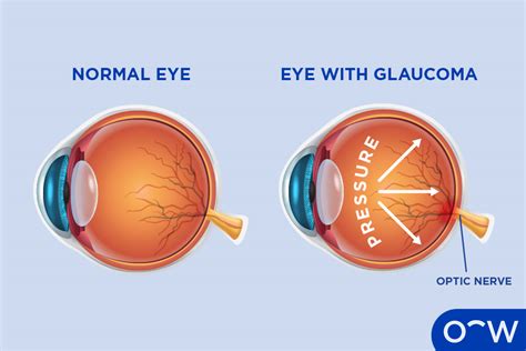 Glaucoma Definition Symptoms Test Causes Treatment