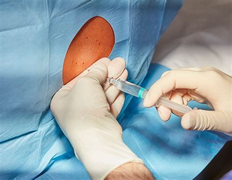 Epidural Injection In New Jersey Gerling Spine Care And Research