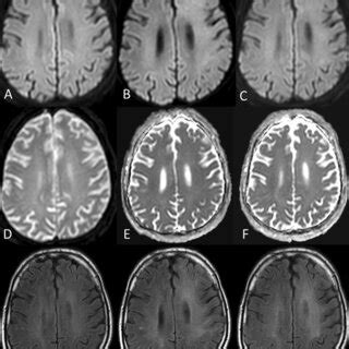 Diffusion Weighted Imaging DWI Top Row Apparent Diffusion