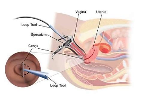 Understanding The Large Loop Excision Of The Transformation Zone Lletz